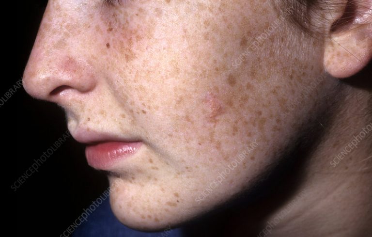 Comedogenic Acne: Understanding Comedogenicity & Acne Cosmetica ...